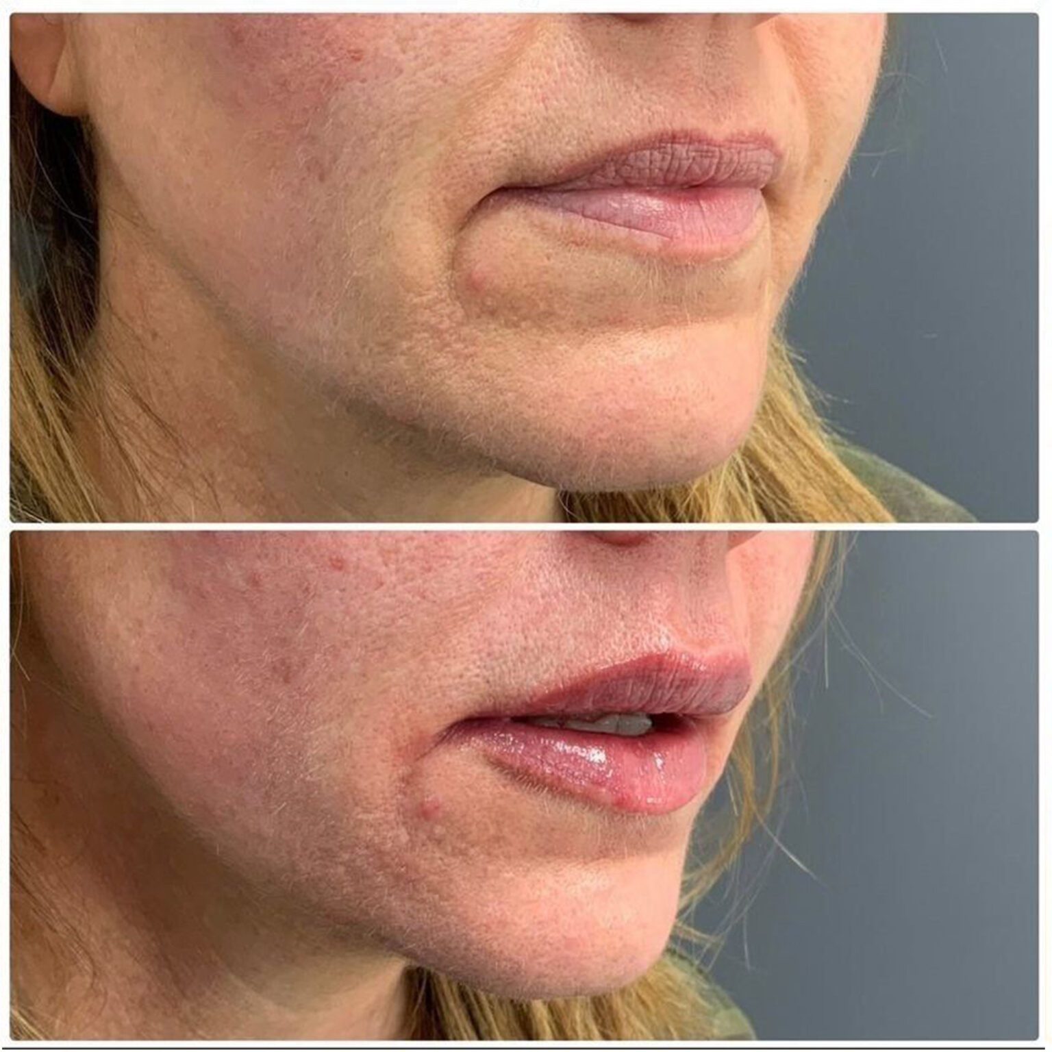 Lip Fillers Guide: Types, Benefits, Costs, and More | YSC