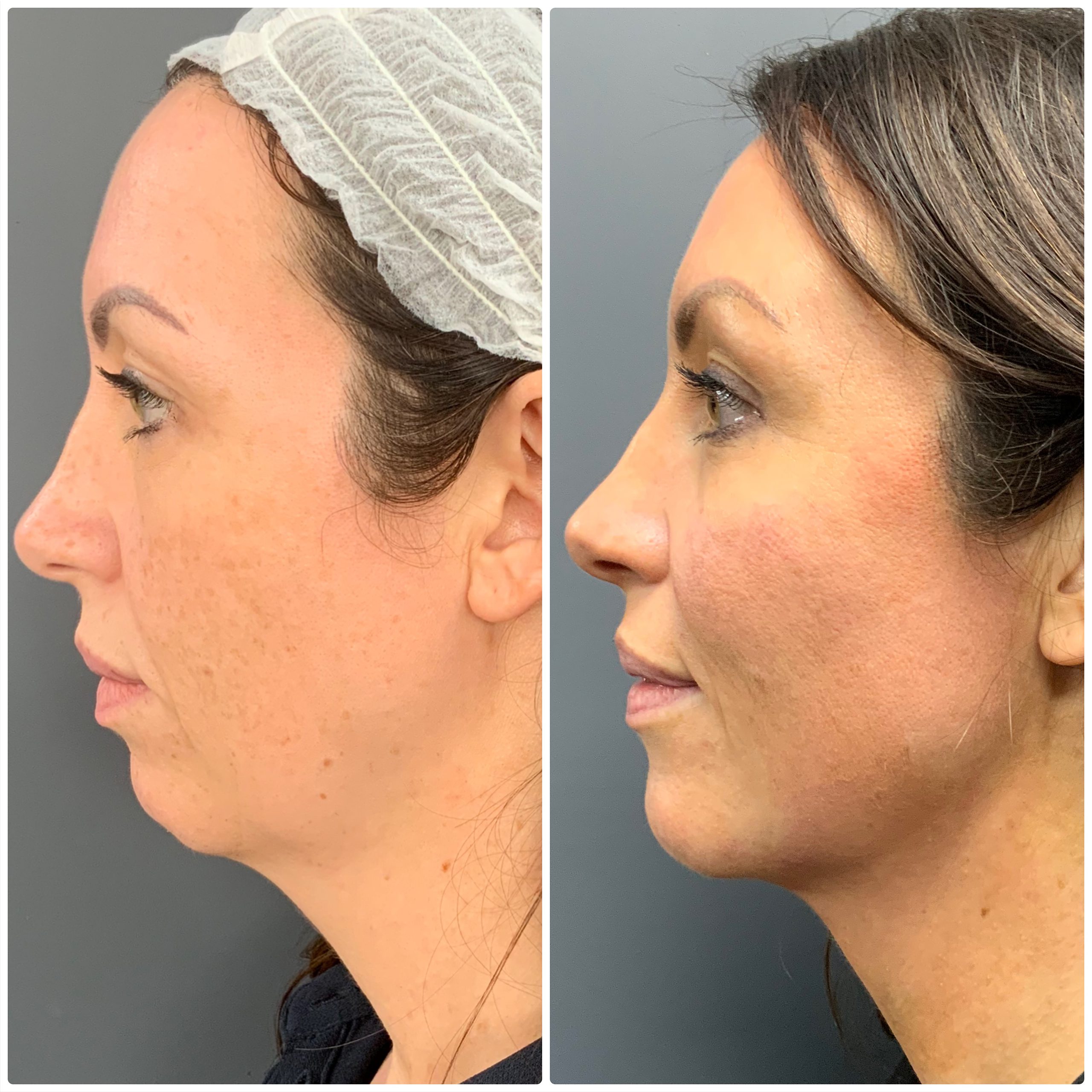 #1 Neck Tightening Treatment Clinic in Leeds, UK