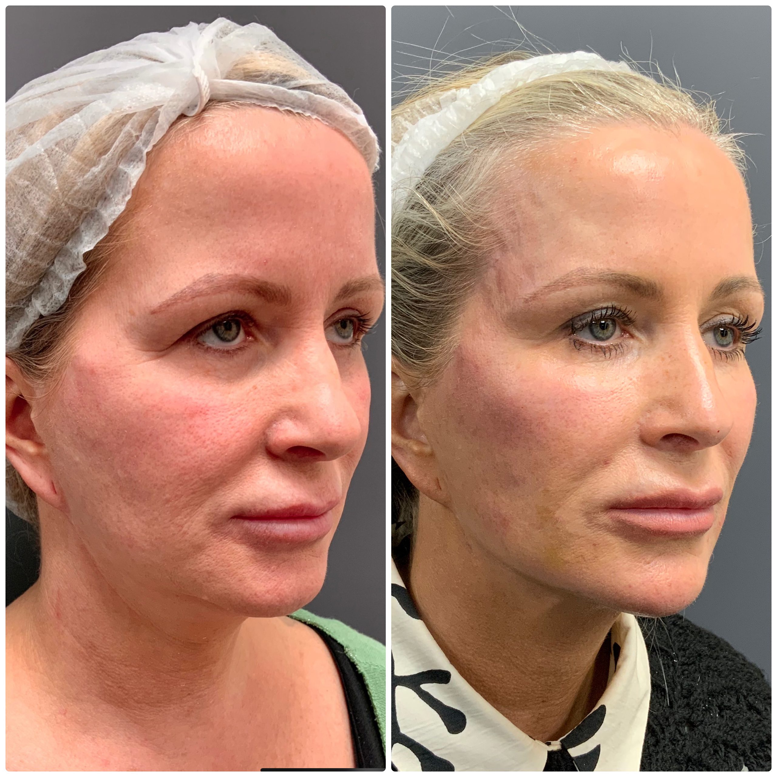 #1 Neck Tightening Treatment Clinic in Leeds, UK