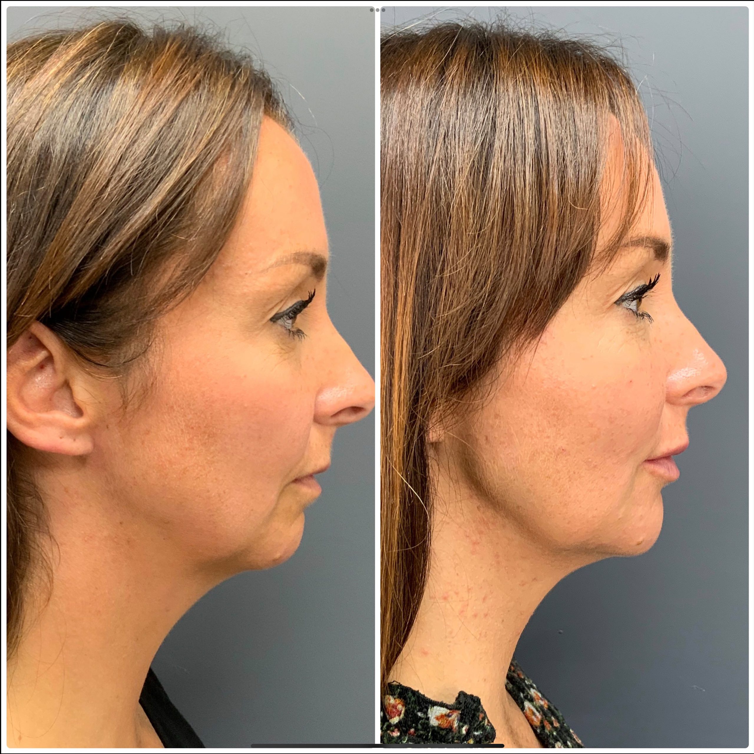 #1 Neck Tightening Treatment Clinic in Leeds, UK