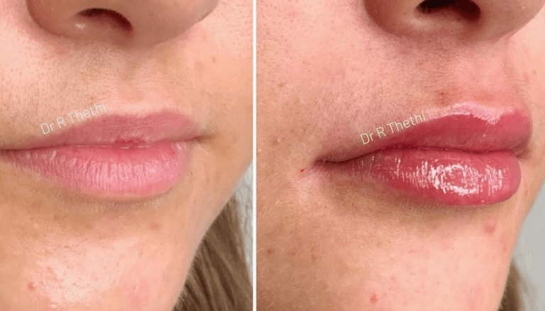 0.5 ml Lip Filler Before and After - Yorkshire Skin Center