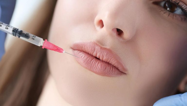 Mastering the 1 ml Russian Lip Filler Technique