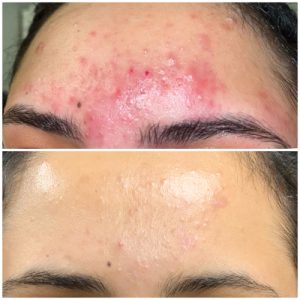 Malar Mounds | Malar Bags: Causes, Symptoms & Treatments