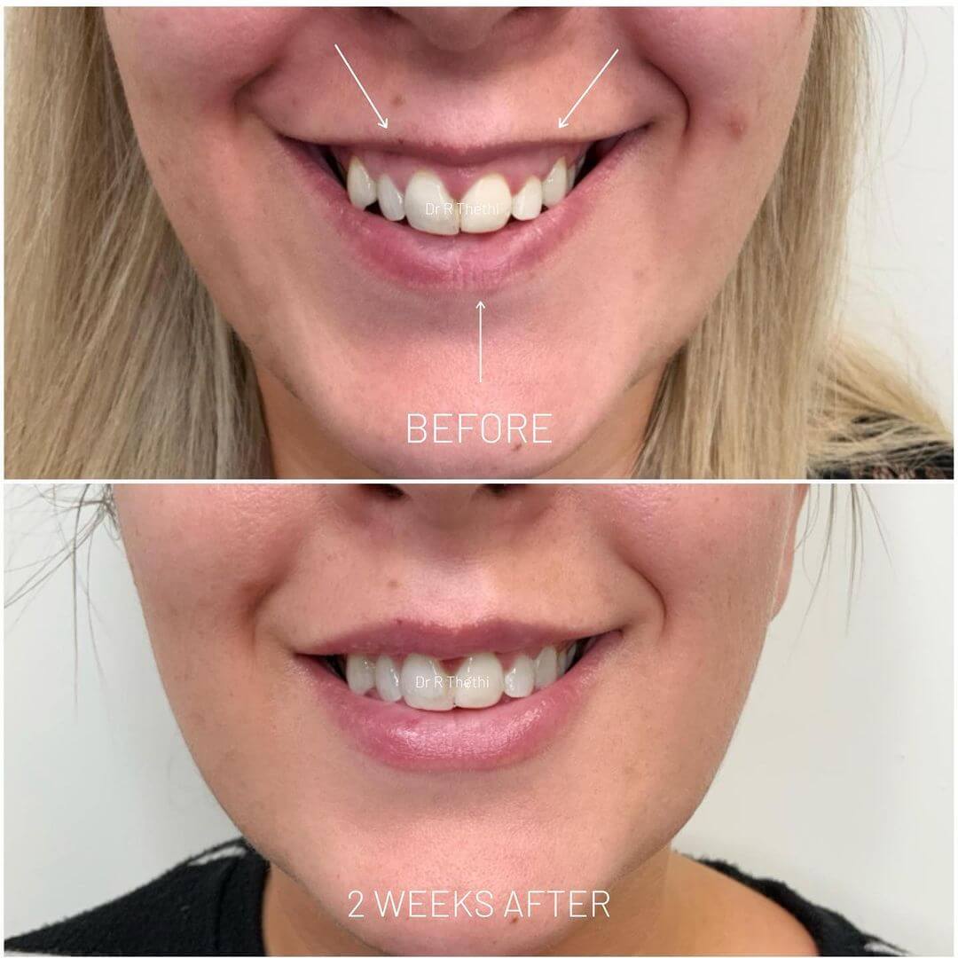 0.5 ml Lip Filler Before and After - Yorkshire Skin Center