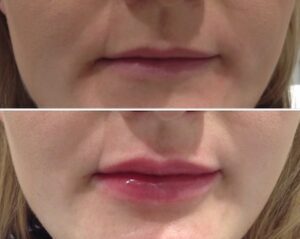 0.5 ml Lip Filler Before and After - Yorkshire Skin Center