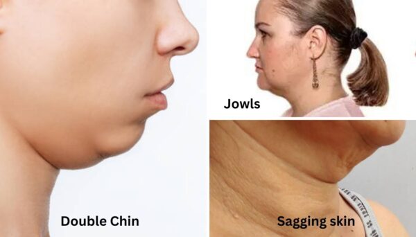 How to Get Rid of Neck Fat? Complete Guide 2024