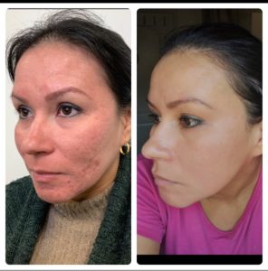 Malar Mounds | Malar Bags: Causes, Symptoms & Treatments