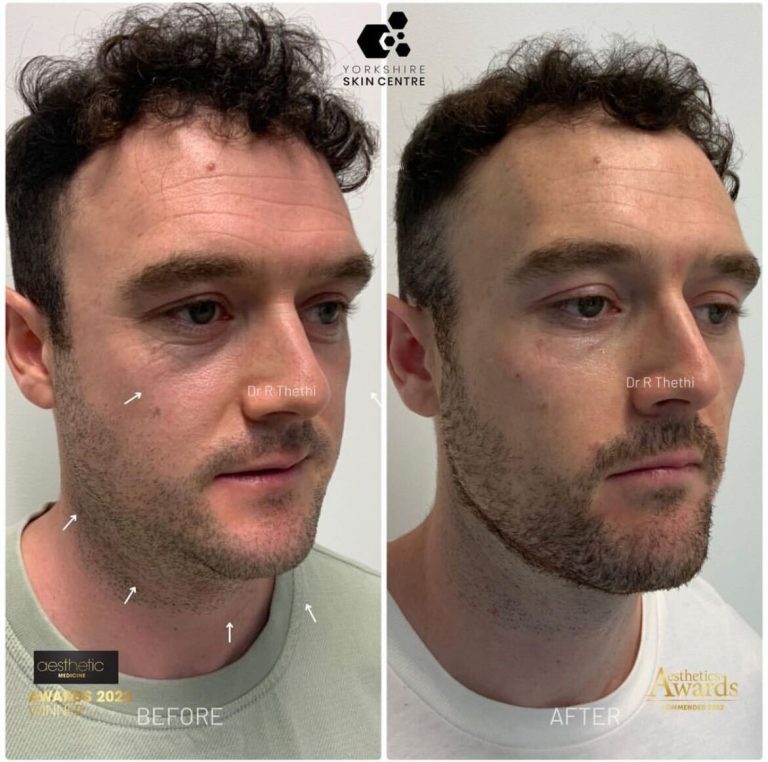 Dermal Fillers For Men Before and After - Yorkshire Skin Centre