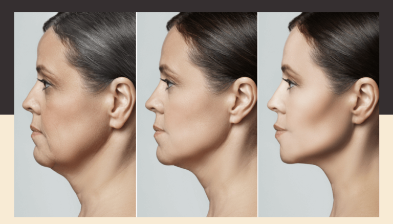 How to Get Rid of a Double Chin? - Yorkshire Skin Centre