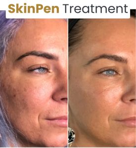 Skin Pen Microneedling Before and After Pictures