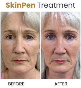 Skin Pen Microneedling Before and After Pictures