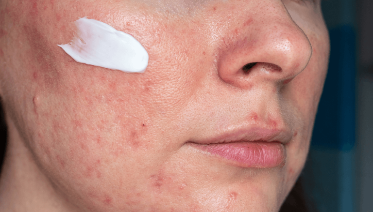 How To Get Rid Of Rosacea Permanently?