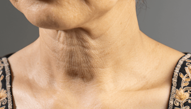 How to Get Rid of Turkey Neck? 5 Effective Tips | YSC
