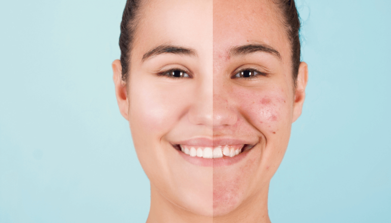 How to Get Rid of Acne Scars : A 2025 Guide