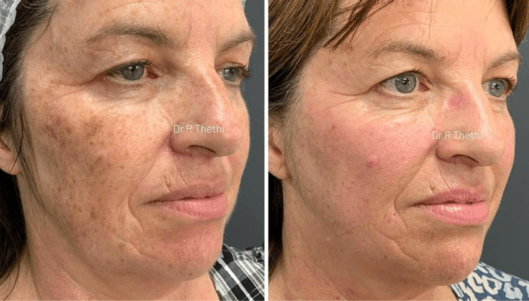 9 Tips On How To Remove Dark Spots On Face