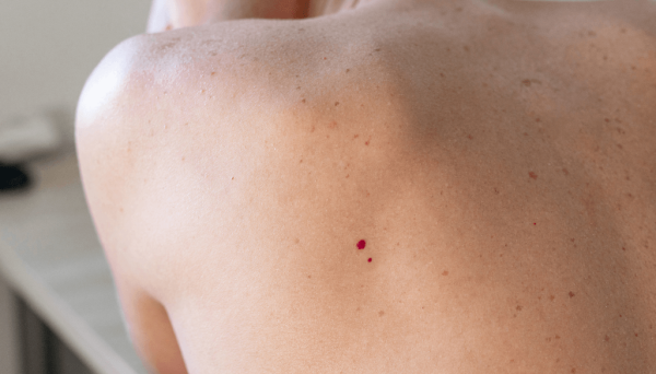 What are Cherry Angiomas? Causes and Removal Methods