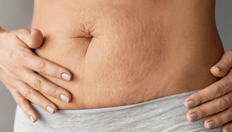 How to Remove Stretch Marks Permanently? Best 2025 Guide