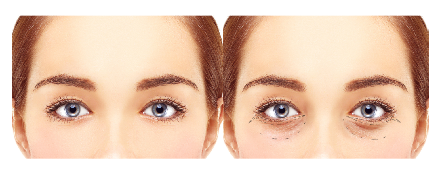 Blepharoplasty Gone Wrong Photos