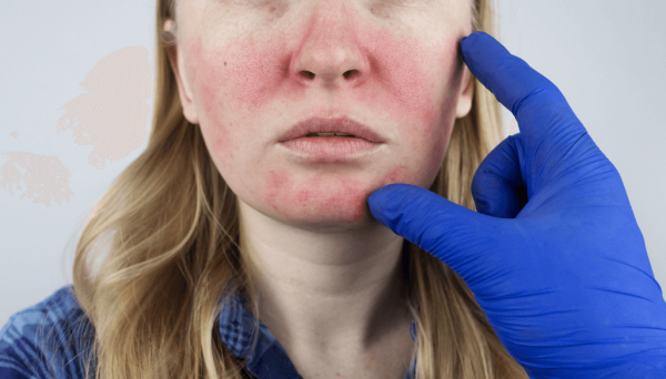 Rosacea Triggers & Tips to Prevent Flare-Ups | Expert Guide