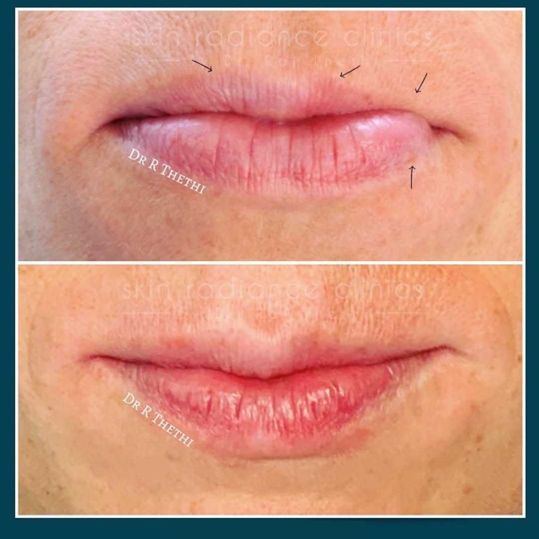 Lip Asymmetry: What It Is, Causes & How to Fix Uneven Lips - YSC