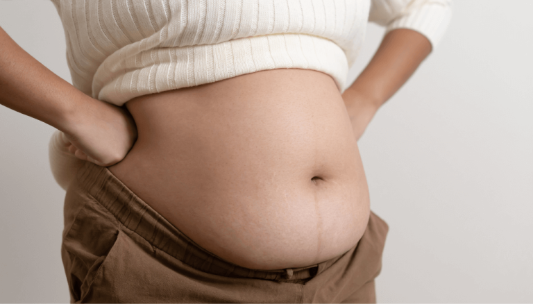 Apron Belly: What It Is, Why It Happens, & How to Reduce It