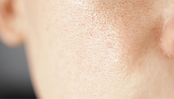 15 Ways on How To Shrink Facial Pores Permanently - YSC