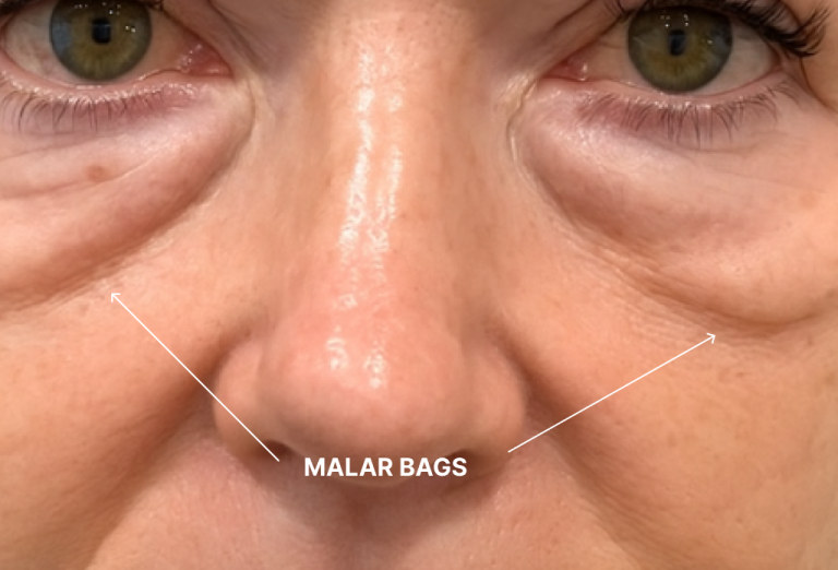 Malar Mounds | Malar Bags: Causes, Symptoms & Treatments