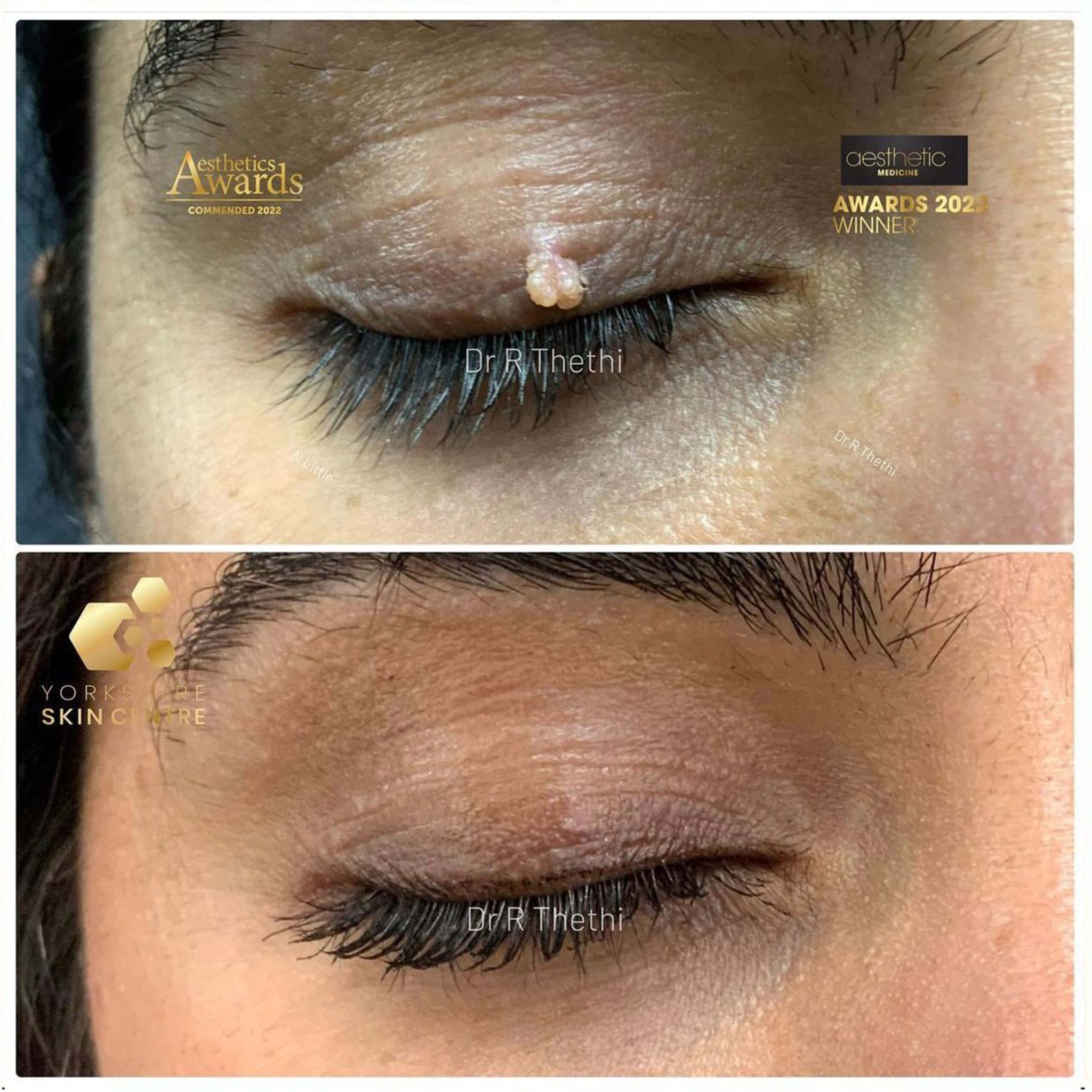 How To Remove Moles From Face: A Complete Guide | YSC