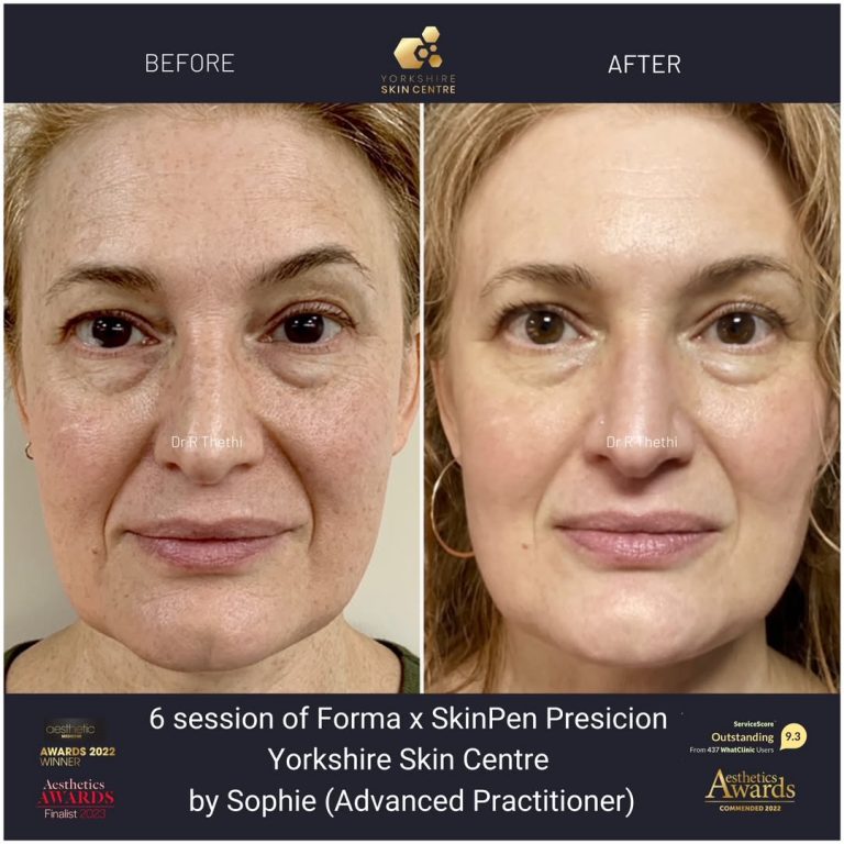 15 Ways on How To Shrink Facial Pores Permanently - YSC