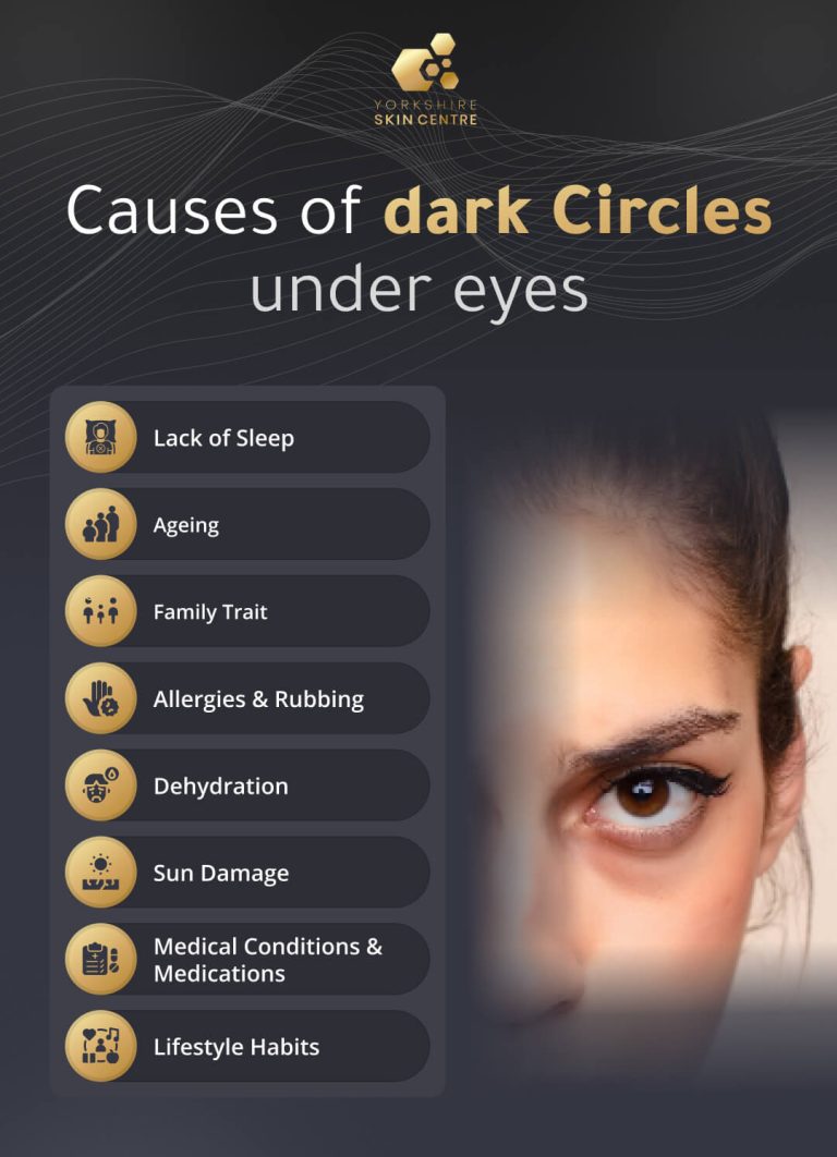 Types of Dark Circles Explained : Yorkshire Skin Centre