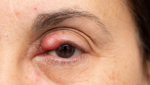 Lip Asymmetry: What It Is, Causes & How to Fix Uneven Lips - YSC
