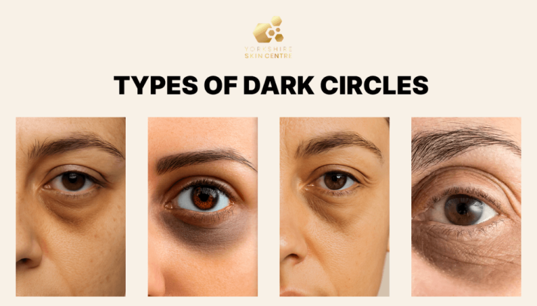 Types of Dark Circles Explained : Yorkshire Skin Centre