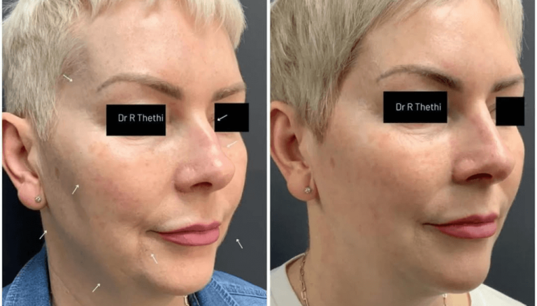 How Long Do Chin Fillers Last? Everything You Need To Know