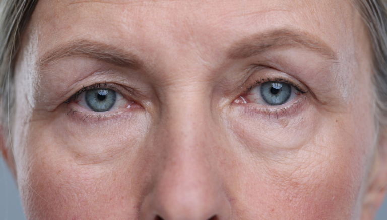 Sunken Eyes: Causes, Home Remedies & Effective Treatments