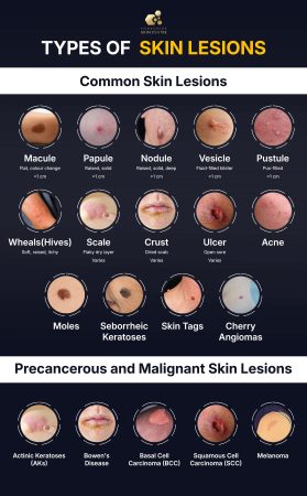 Skin Lesions Types | Complete Guide - Yorkshire Skin Centre