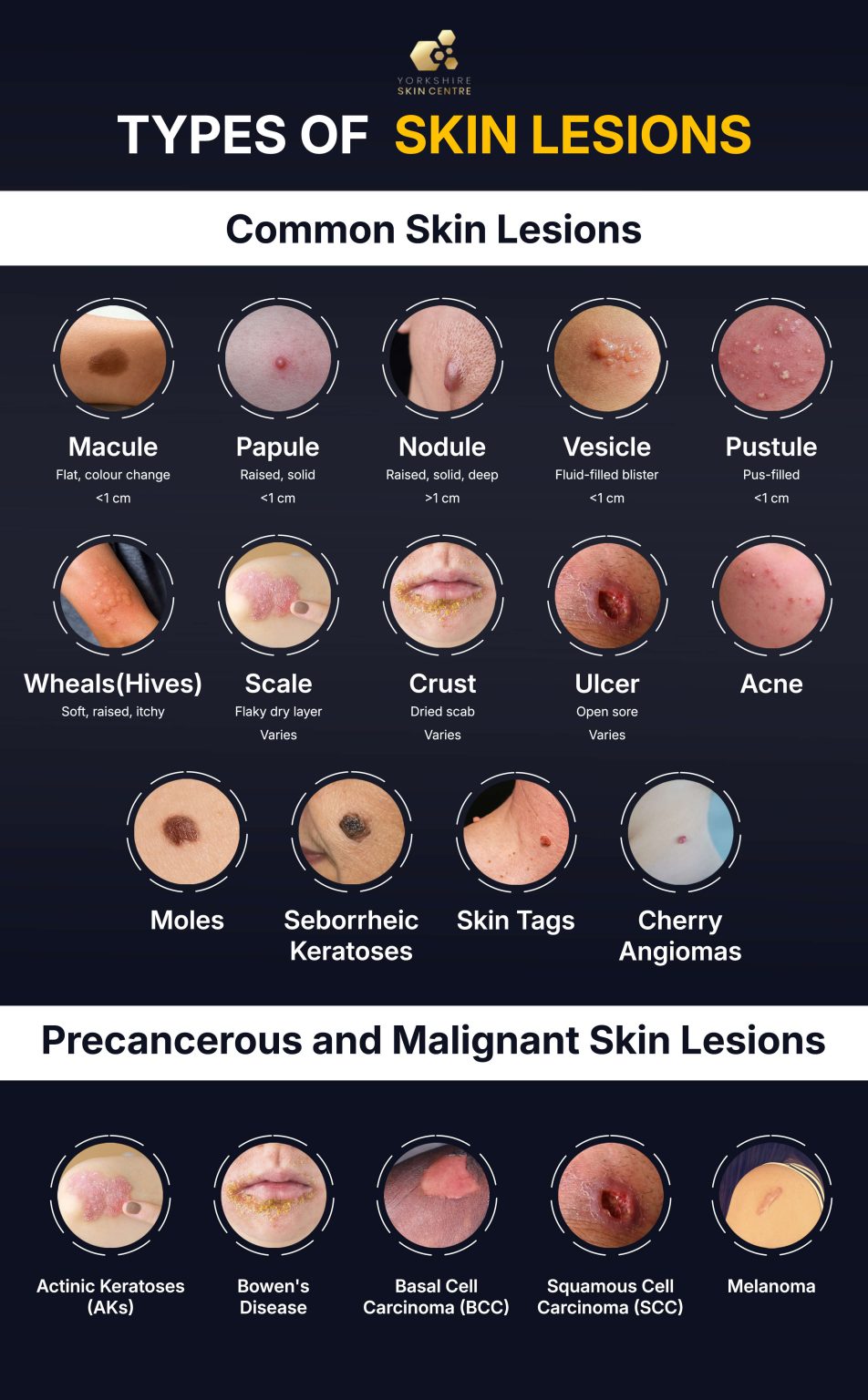 Skin Lesions Types | Complete Guide - Yorkshire Skin Centre
