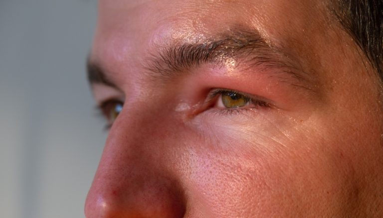 Tear Trough Filler: Benefits, Procedure, Cost & Safety - YSC